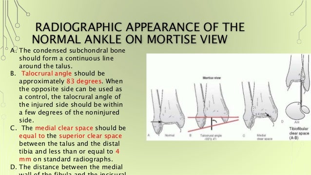 Ankle Fractures