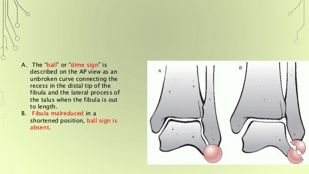 Ankle Fractures