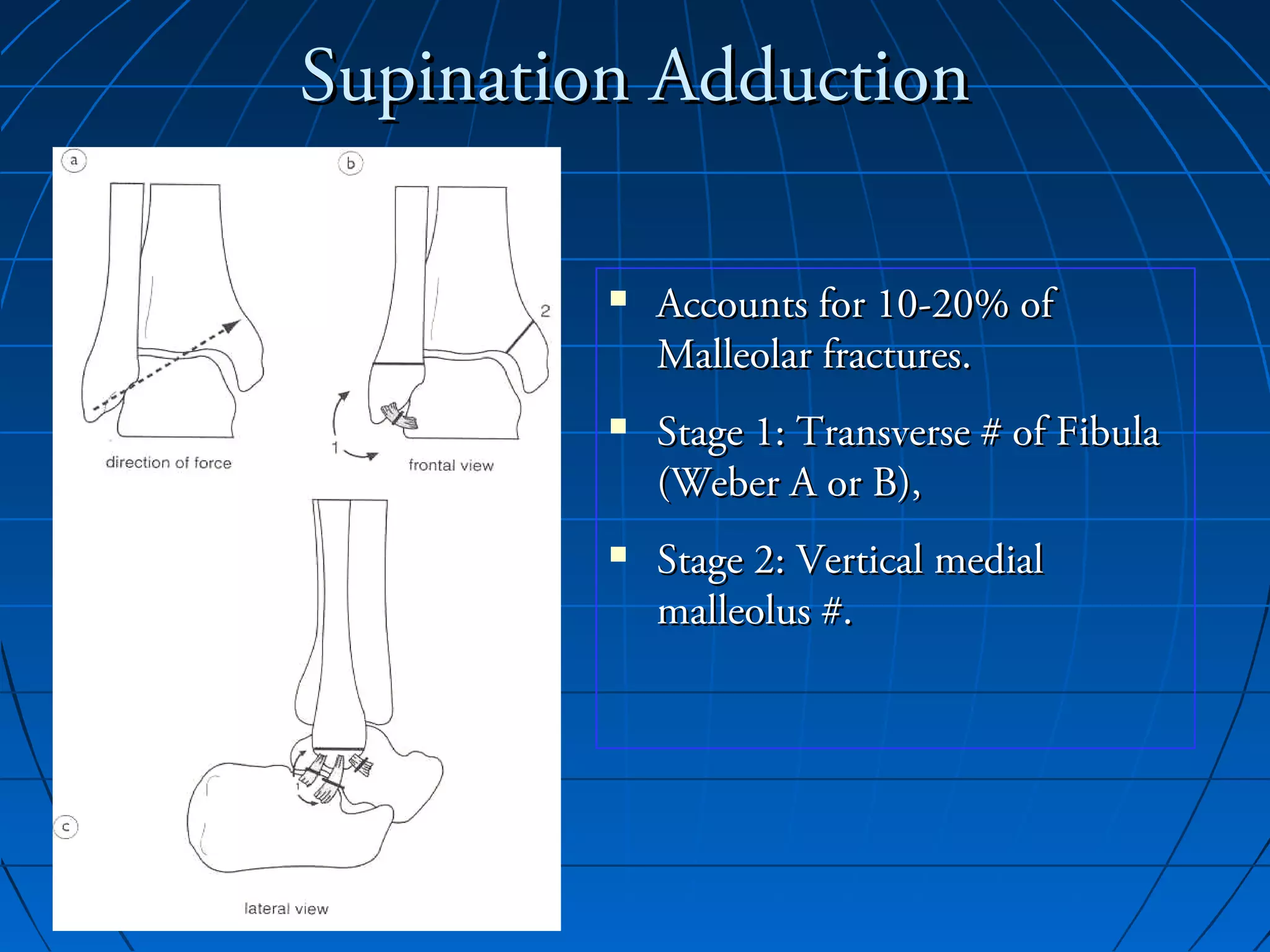 Ankle fractures | PPT