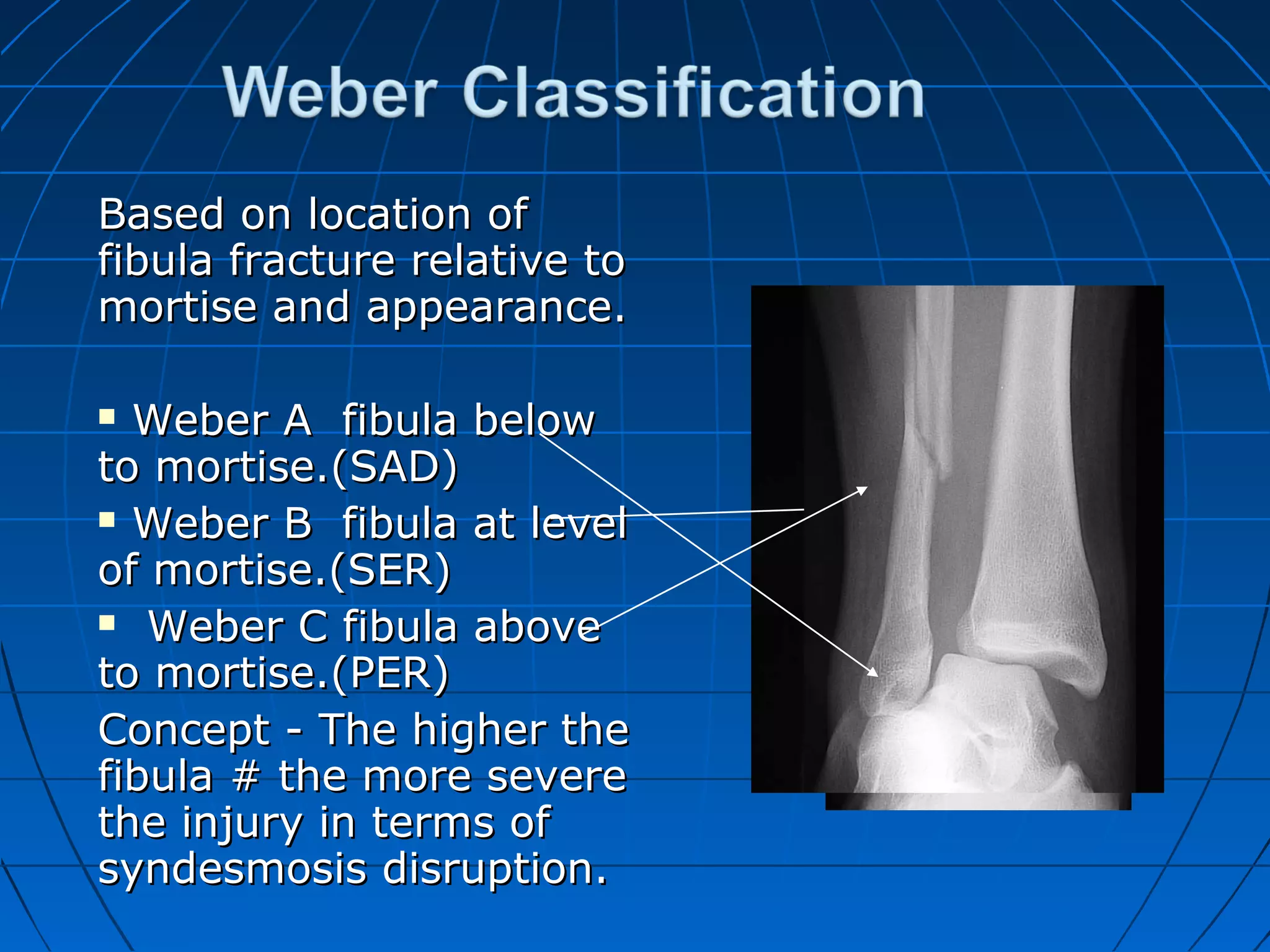Ankle fractures | PPT