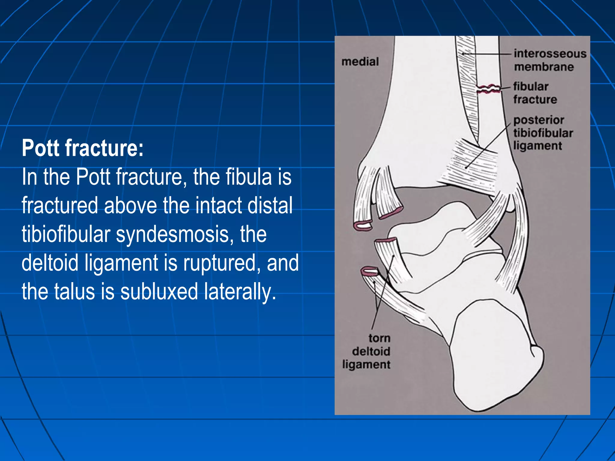 Ankle fractures | PPT