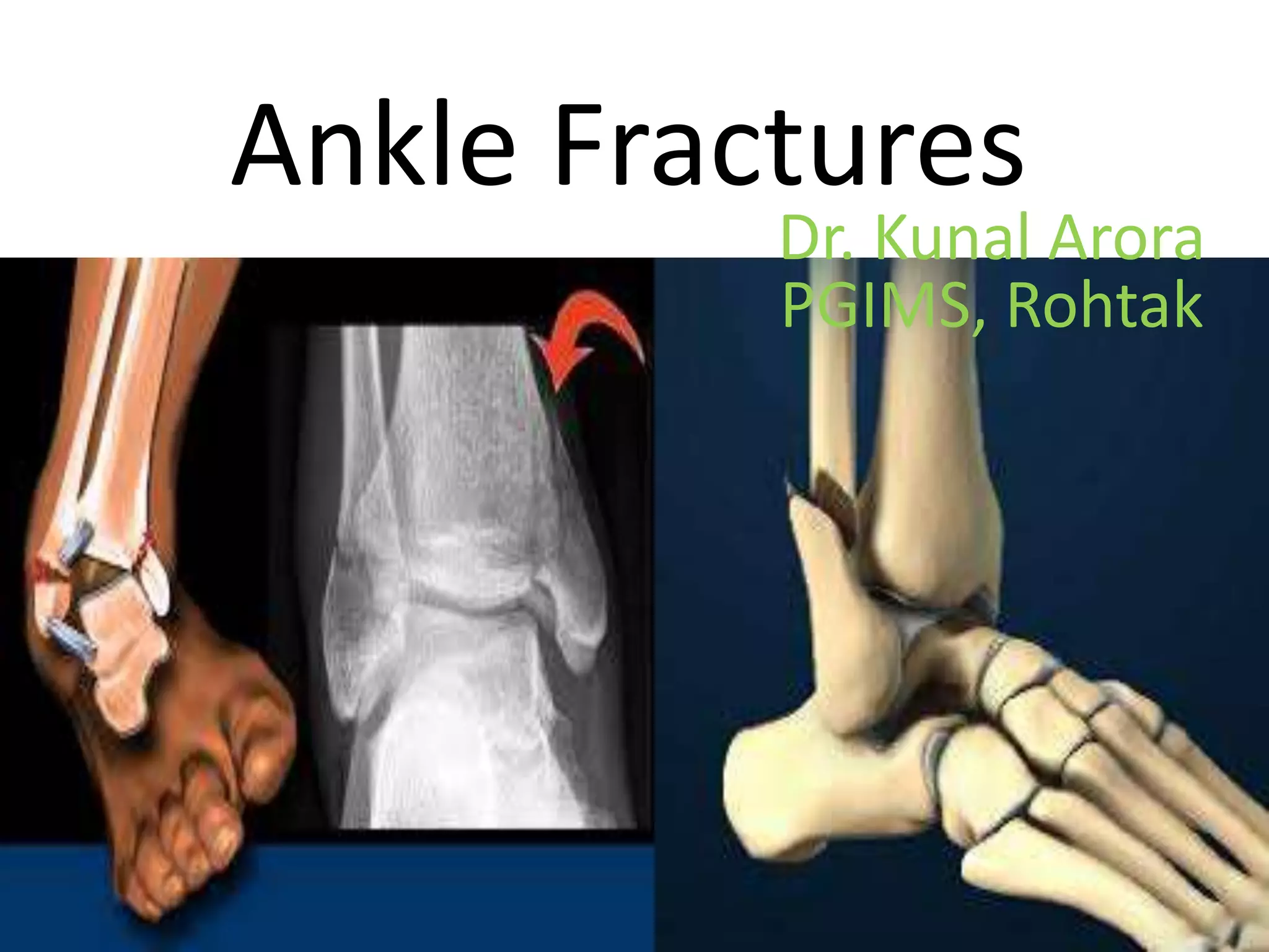 Ankle fractures | PPTX