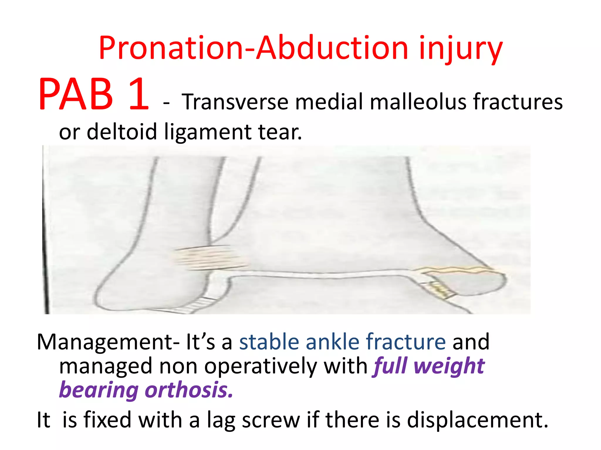Ankle fractures | PPTX