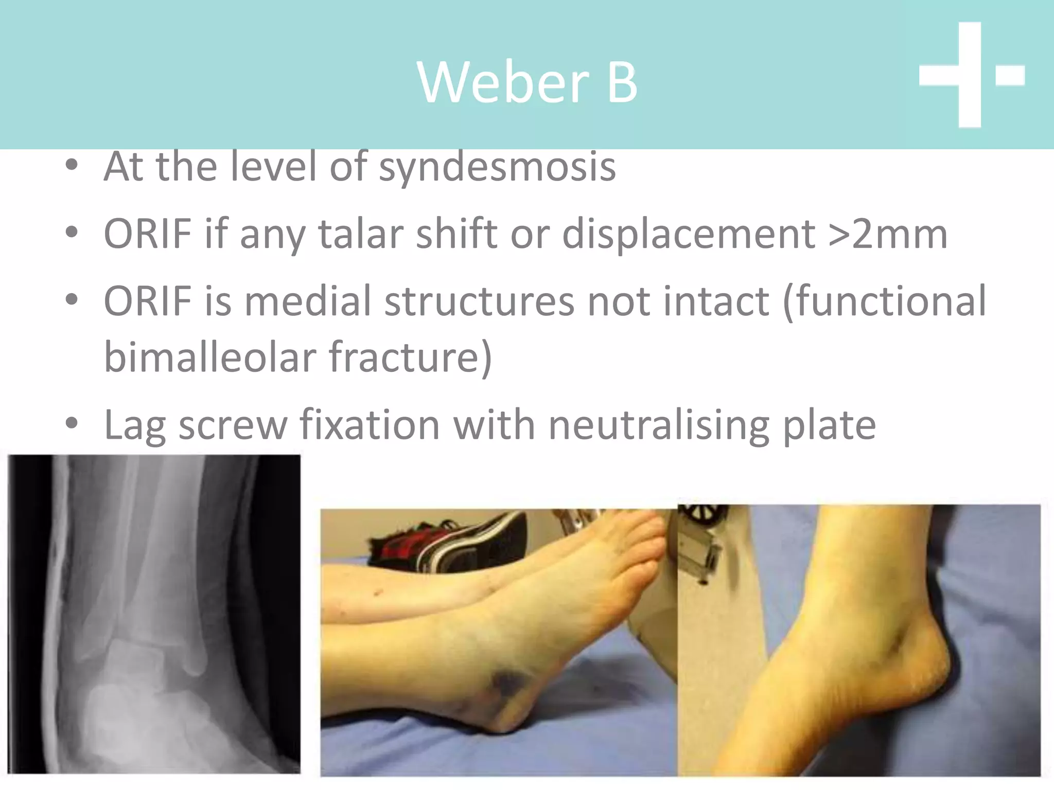 Ankle fractures and dislocations | PPTX