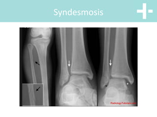 Ankle fractures and dislocations | PPTX