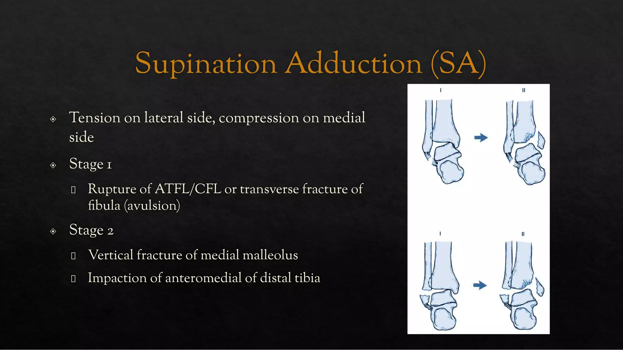 ANKLE FRACTURES.pdf