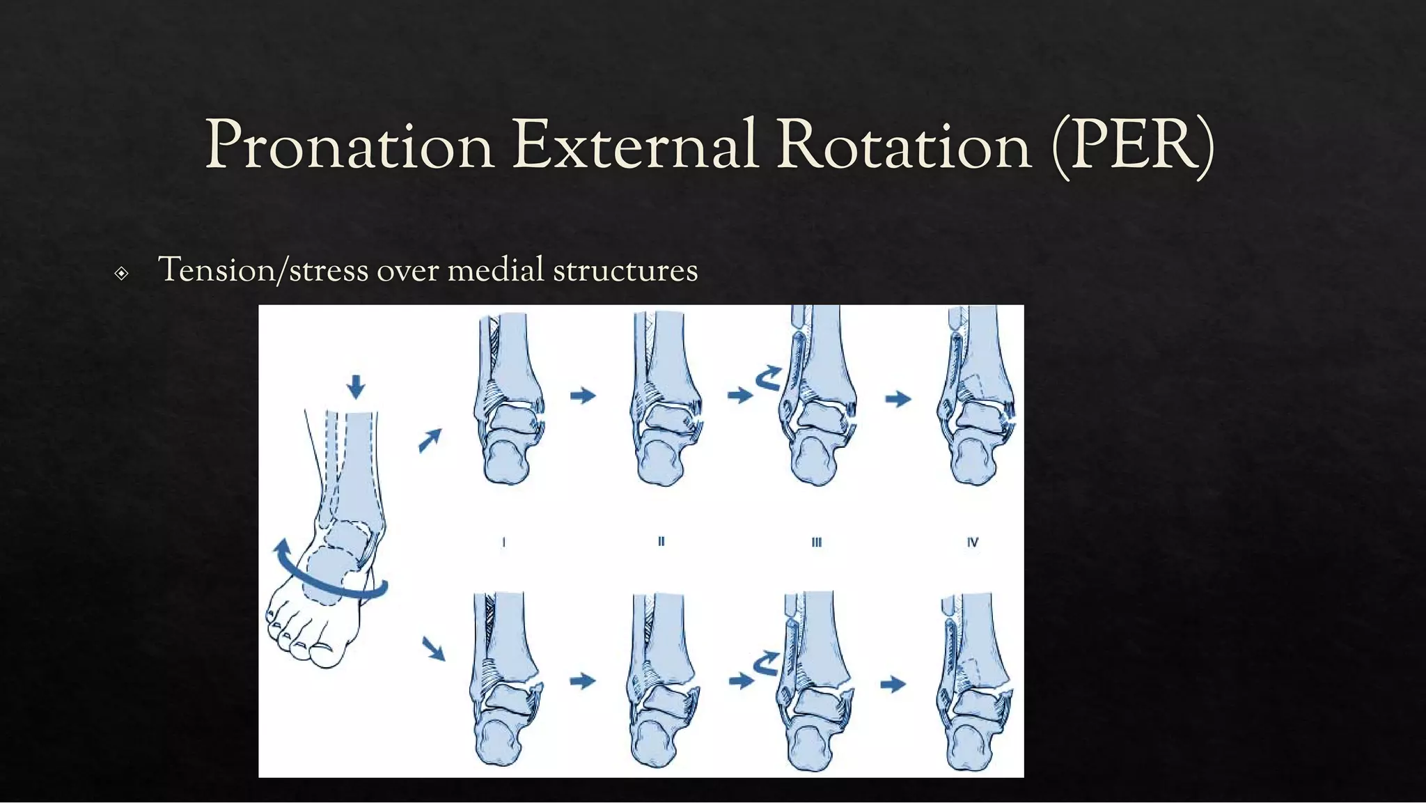 ANKLE FRACTURES.pdf