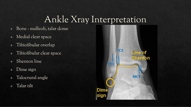ANKLE FRACTURES.pdf