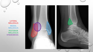 Ankle fractures.pptx