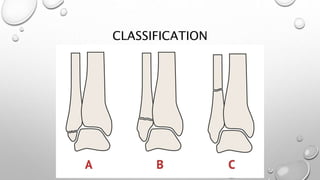 Ankle fractures.pptx