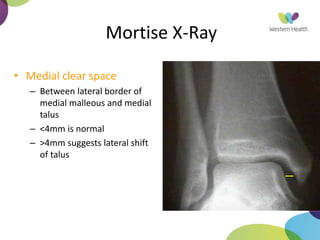 Ankle Fractures.ppt