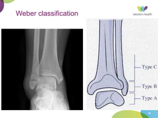 Ankle Fractures.ppt