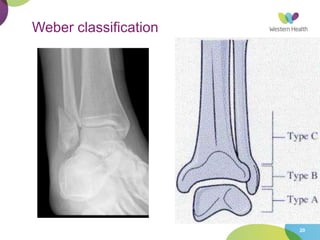 Ankle Fractures.ppt