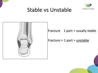 Ankle Fractures.ppt