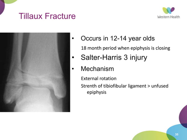 Ankle Fractures.ppt