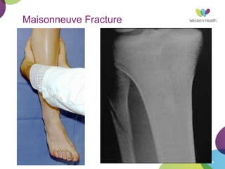Ankle Fractures.ppt