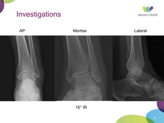 Ankle Fractures.ppt