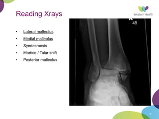 Ankle Fractures.ppt