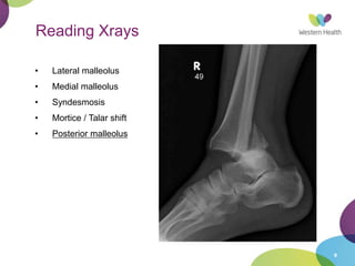 Ankle Fractures.ppt