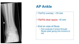 ankle fractures.pptx