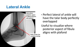 ankle fractures.pptx