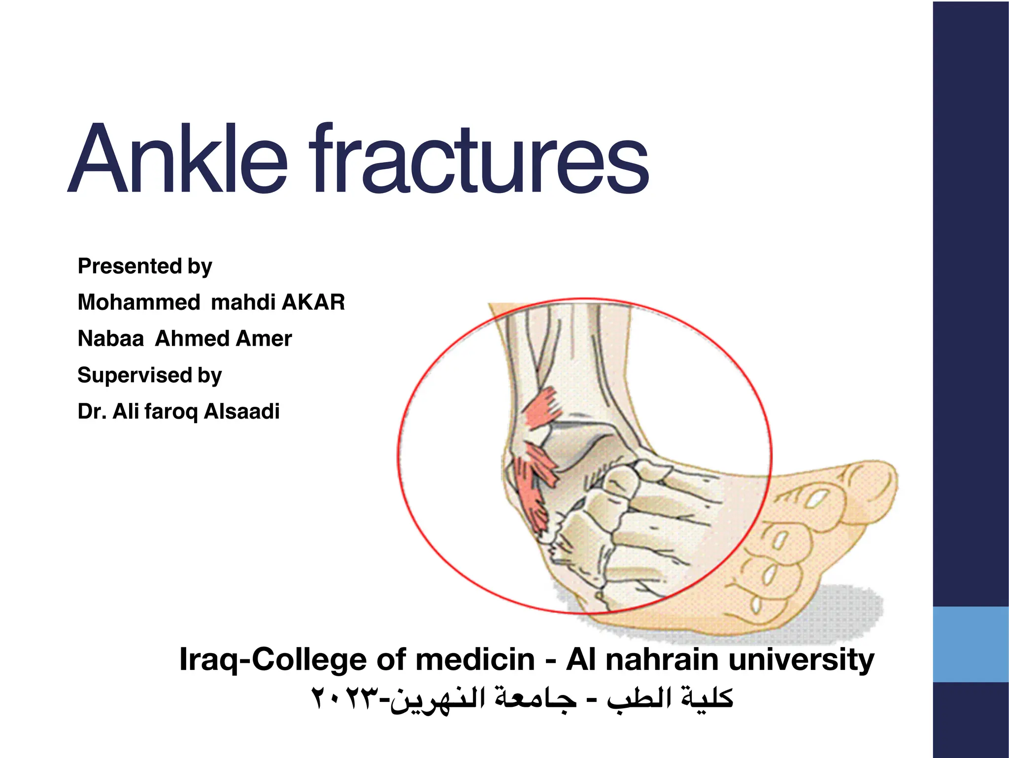 Ankle fractures.pdf