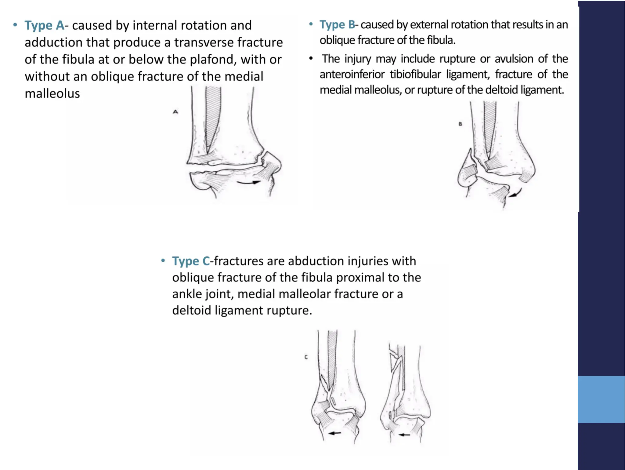 Ankle fractures.pdf