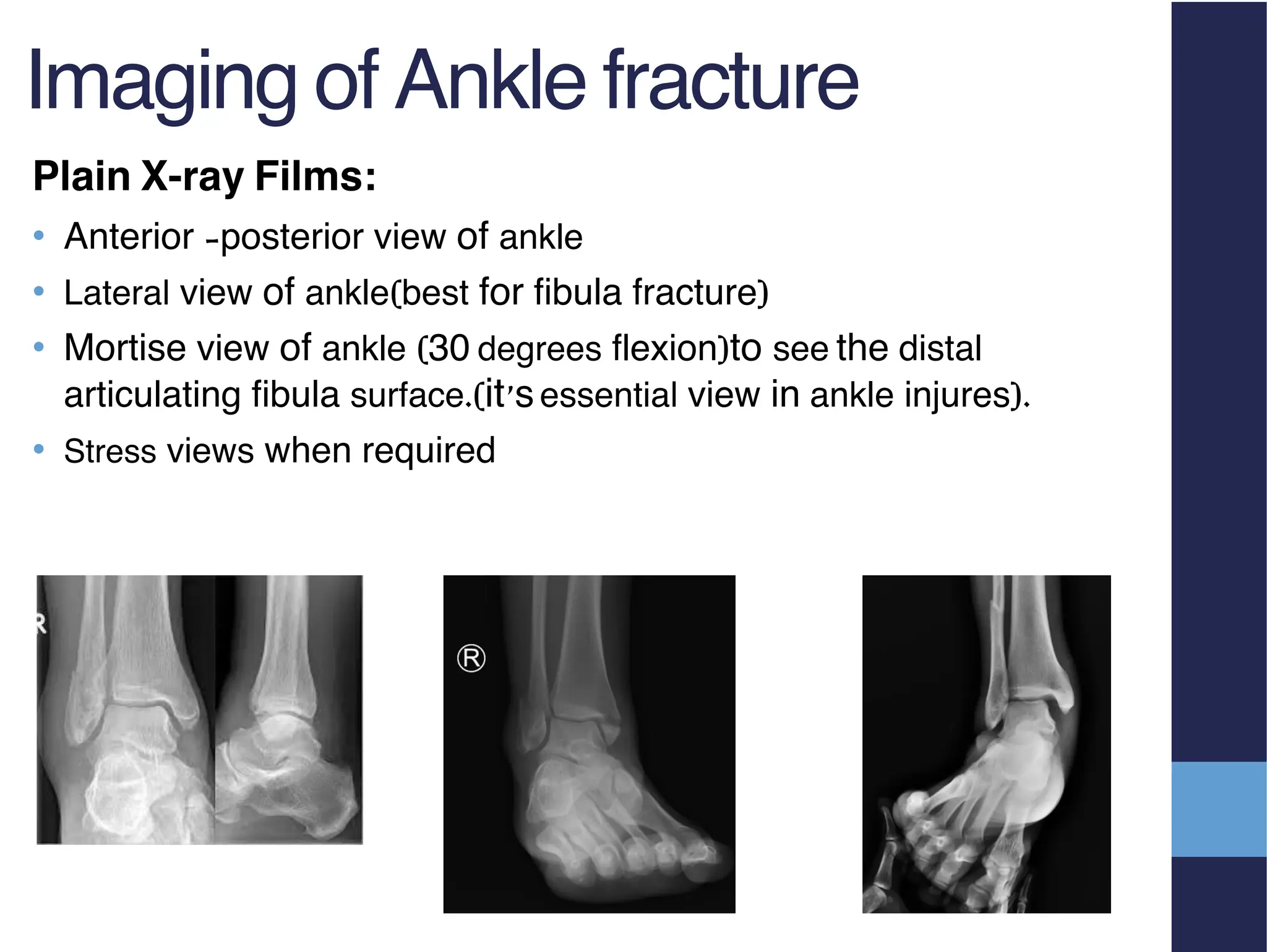 Ankle fractures.pdf