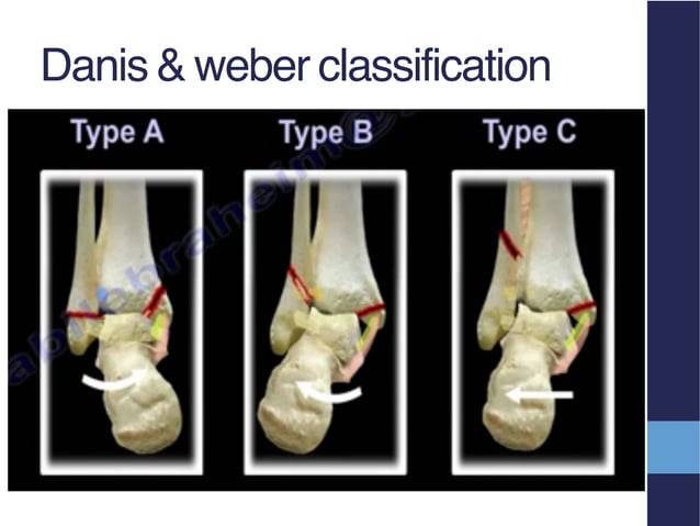Ankle fractures.pdf