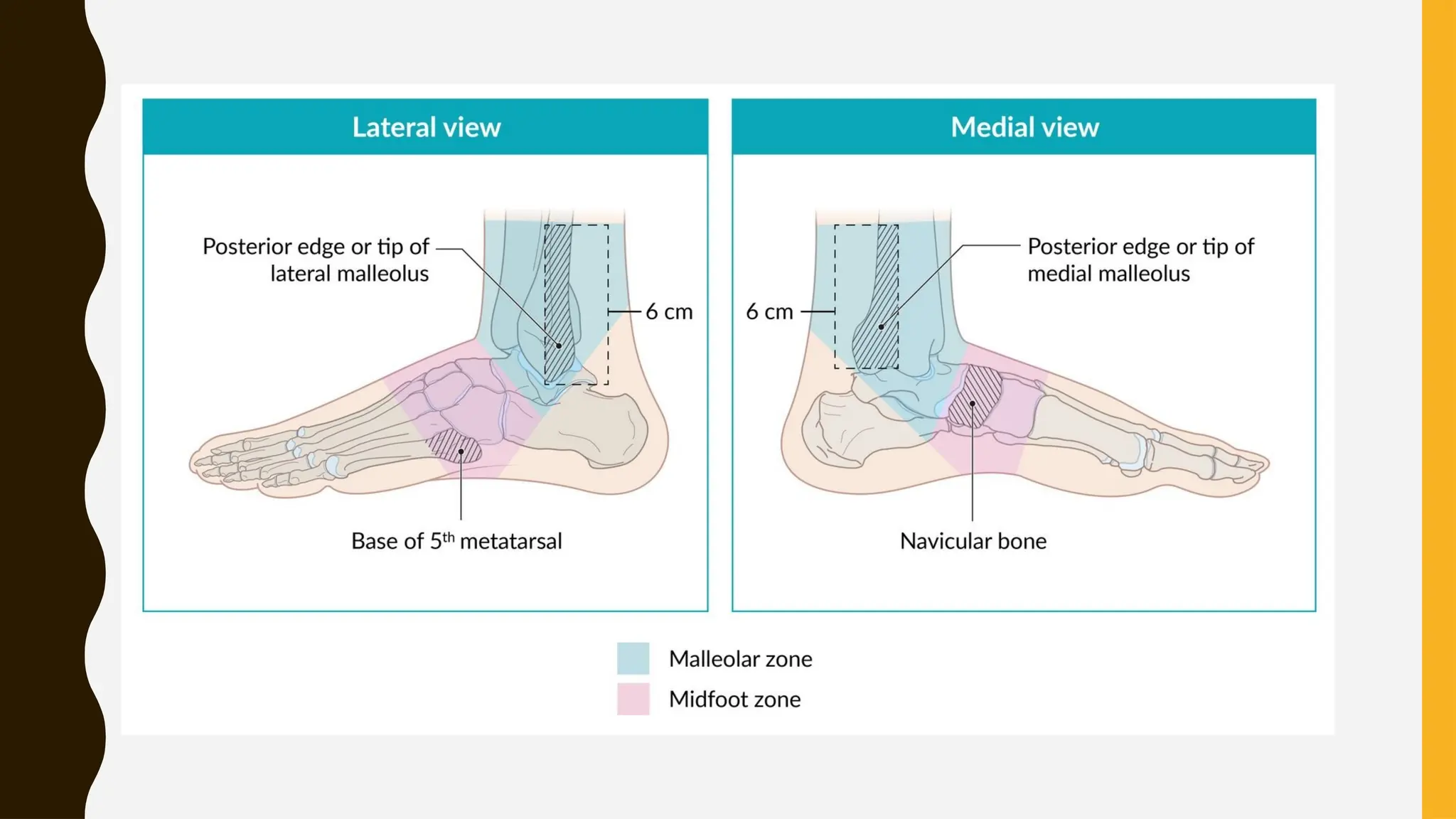 Ankle fractures and how to interpret X-ray | PPTX