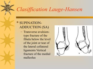 ANKLE FRACTURES, Anatomi, Stability, Main Ligamentous system | PPT