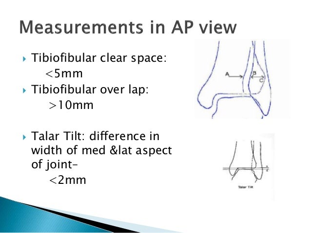 Ankle fractures management