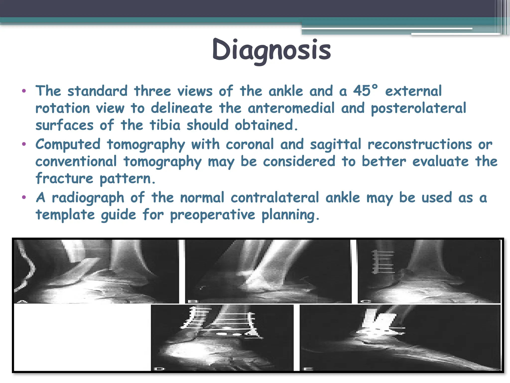 ANKLE and. foot FRACTURES 2021 (2).pptx
