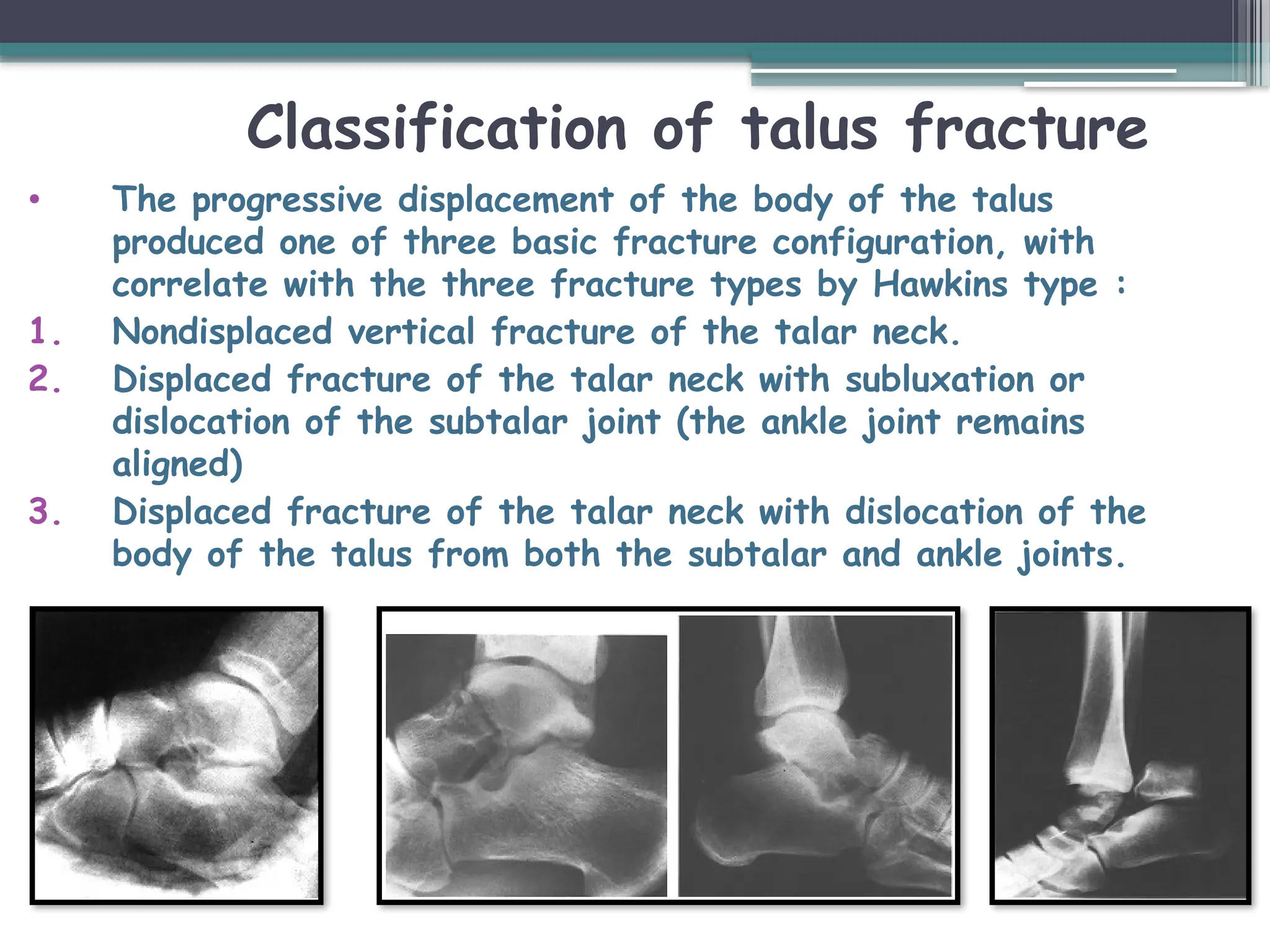 ANKLE and. foot FRACTURES 2021 (2).pptx