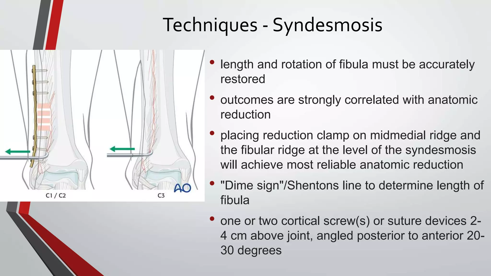 Ankle Fractures and Syndesmosis.pptx