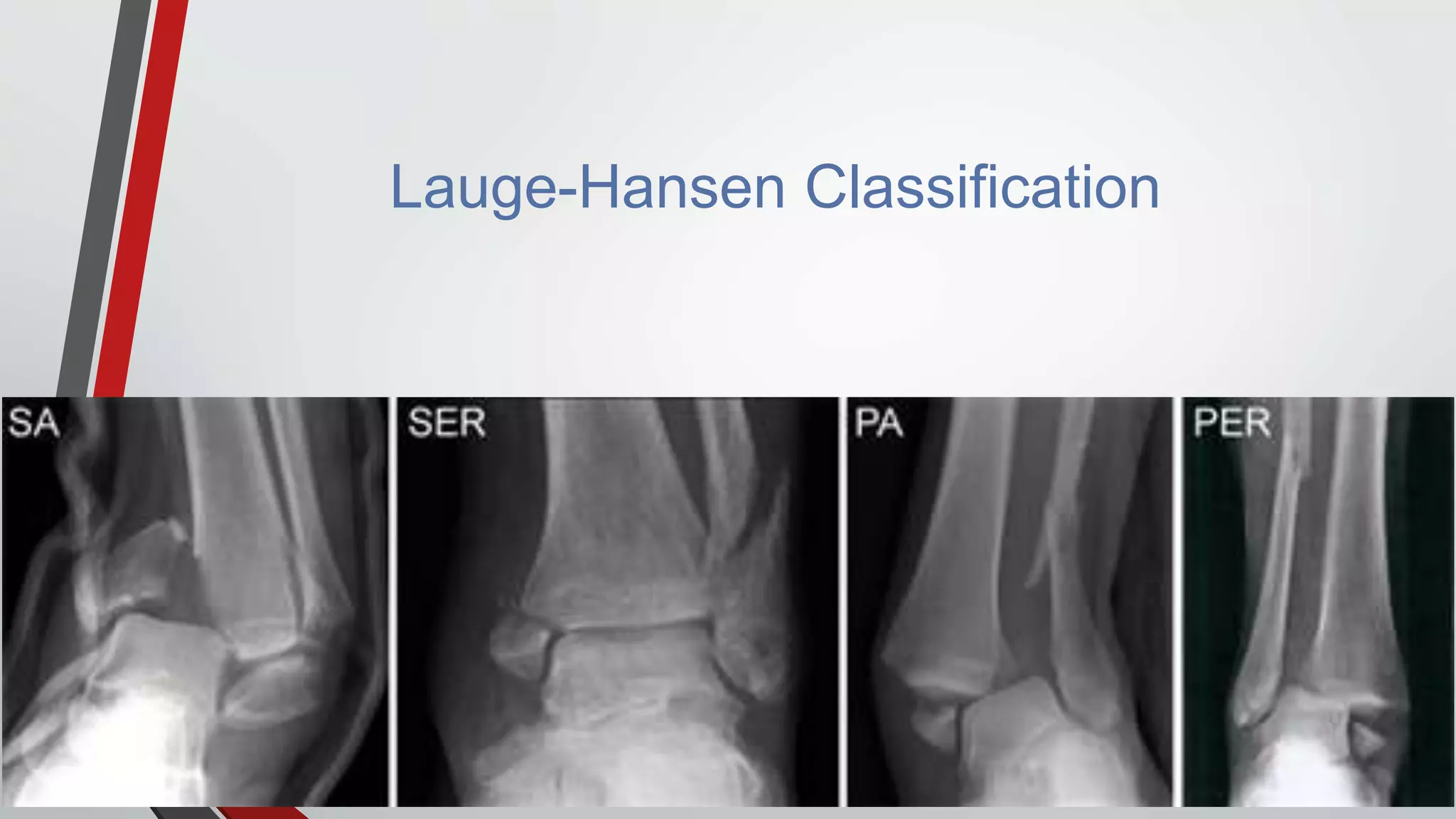 Ankle Fractures and Syndesmosis.pptx