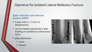 Ankle Fractures and Syndesmosis.pptx