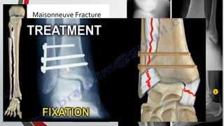 Ankle Fractures and Syndesmosis.pptx