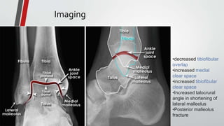 Ankle Fractures and Syndesmosis.pptx