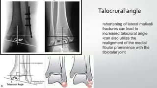 Ankle Fractures and Syndesmosis.pptx