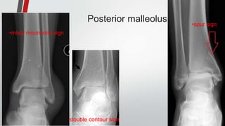Ankle Fractures and Syndesmosis.pptx