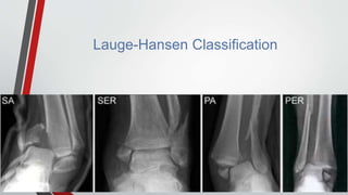 Ankle Fractures and Syndesmosis.pptx