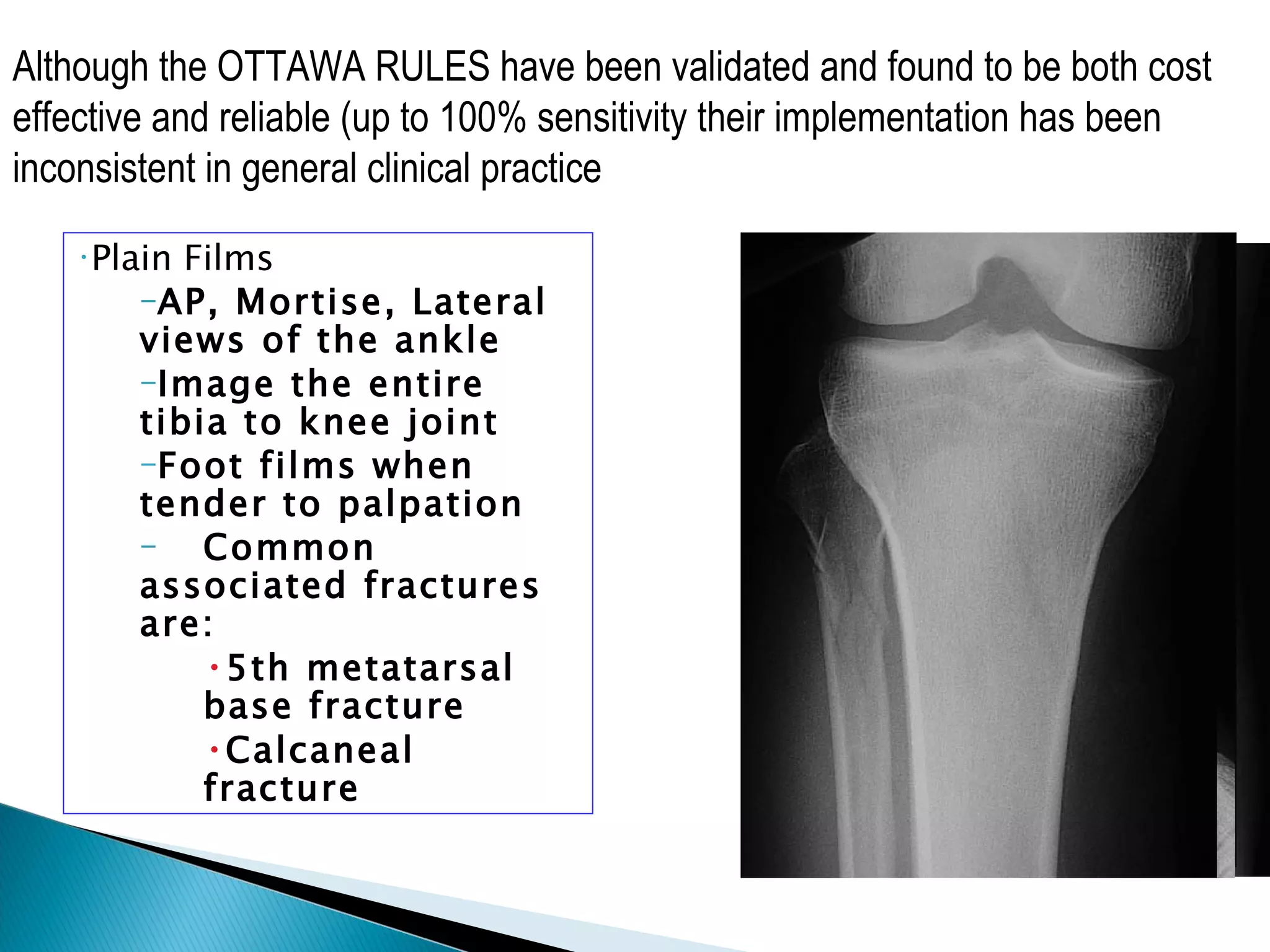 Ankle fractures final | PPT