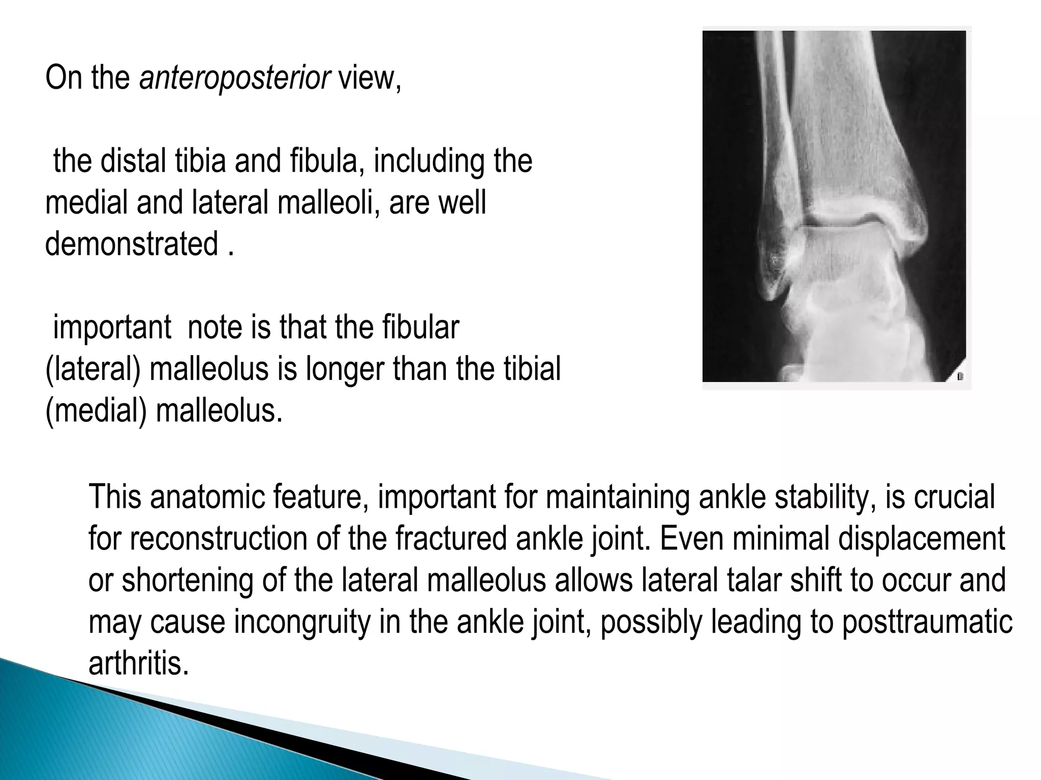 Ankle fractures final | PPT