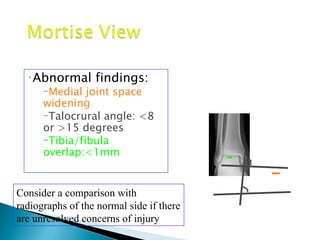 Ankle fractures final | PPT