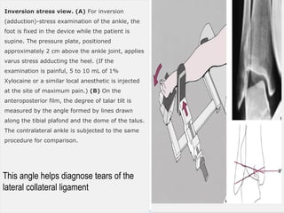 Ankle fractures final | PPT
