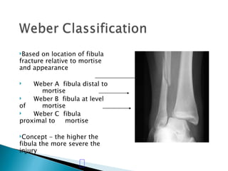 Ankle fractures final | PPT