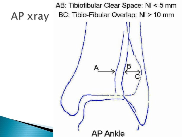 Ankle fractures final