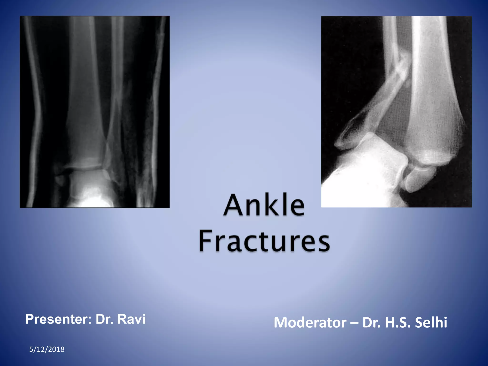 Ankle fractures final | PPTX