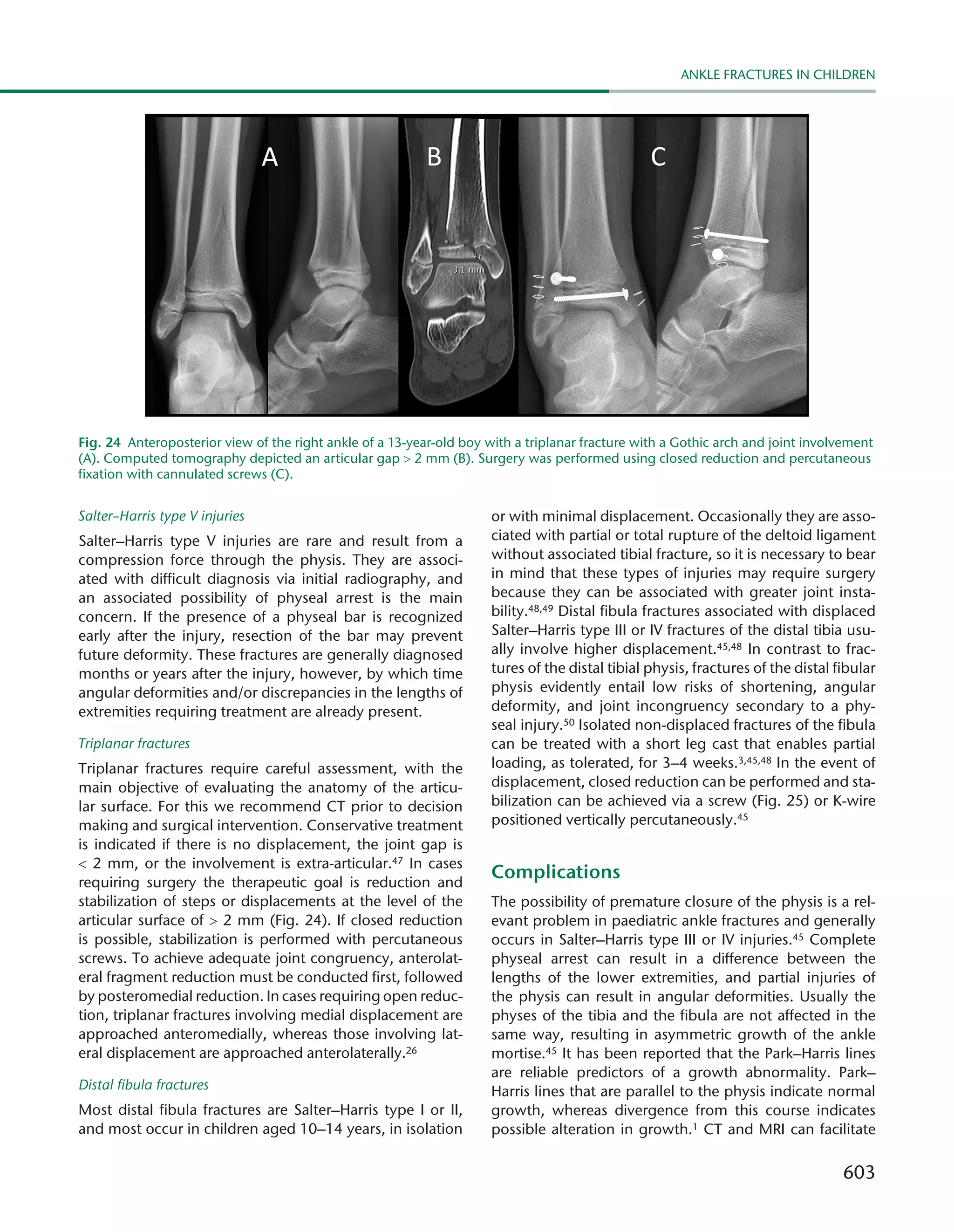 Ankle fractures in children 2021 | PDF